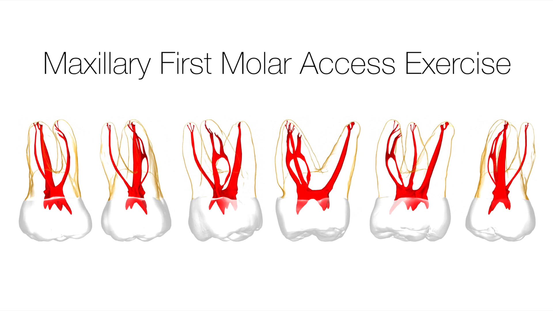 8. Access Exercise on Maxillary First Molar #3 | Delendo Courses Online